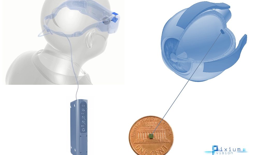 First US Patient Gets Wireless Retinal Device Implant | INVISIONMAG.COM